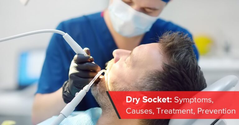 Dry Socket: Symptoms, Causes, Treatment, Prevention